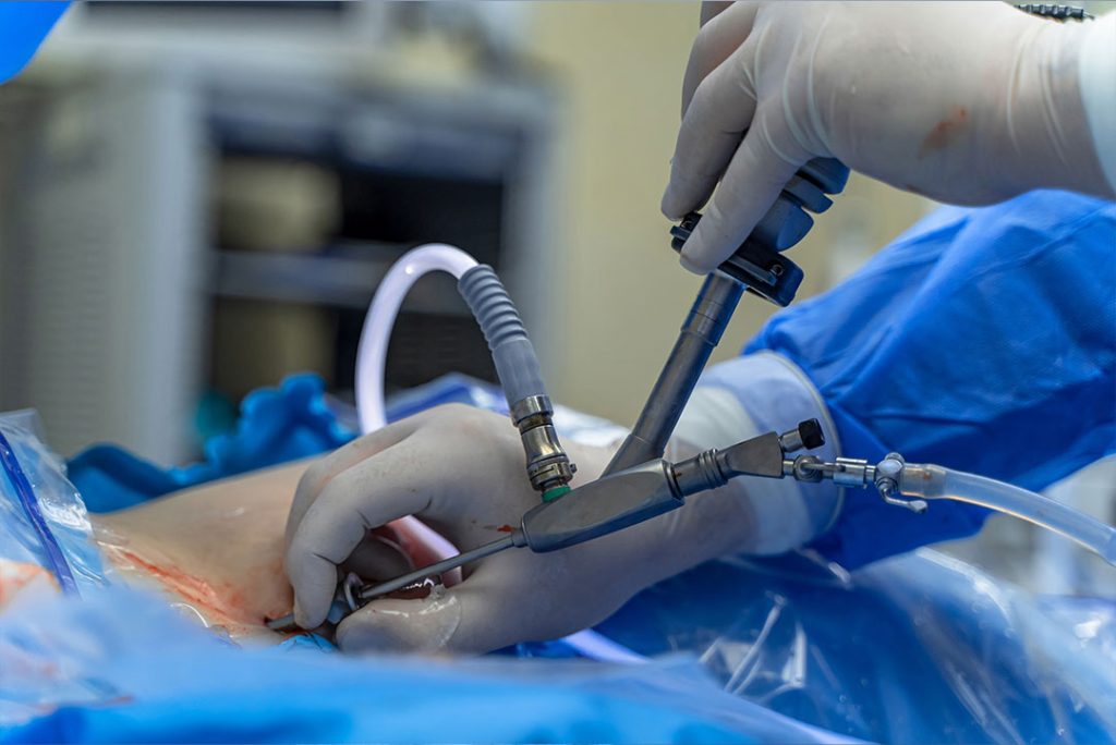 What Is Full Endoscopic Surgery? - ClinicHaus